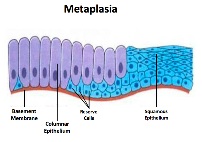 O que é Metaplasia?