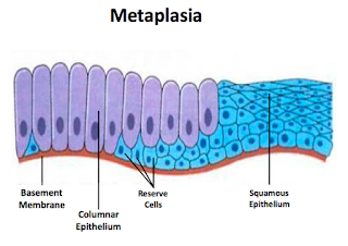 O que é Metaplasia?