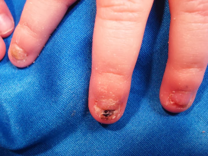 VIRTUAL GRAND ROUNDS IN DERMATOLOGY 2.0: Periodic Shedding of the Nails
