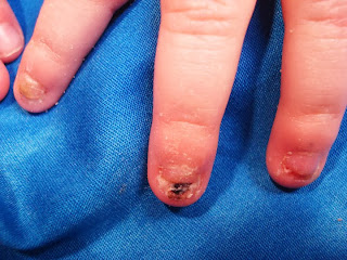 VIRTUAL GRAND ROUNDS IN DERMATOLOGY 2.0: Periodic Shedding of the Nails