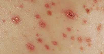 Kallan kuvernööri: Kuolemaan johtava vesirokko