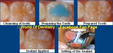 :: World Of Dentistry ::: Fissure Sealants