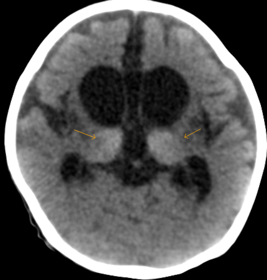 Hyperdense Thalami-CT - Sumer's Radiology Blog