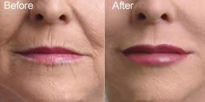 Selston Cosmetic Clinic: Lip Creases / Dermal Fillers - Nottingham ...