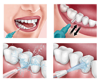 Dental cleaning illustration