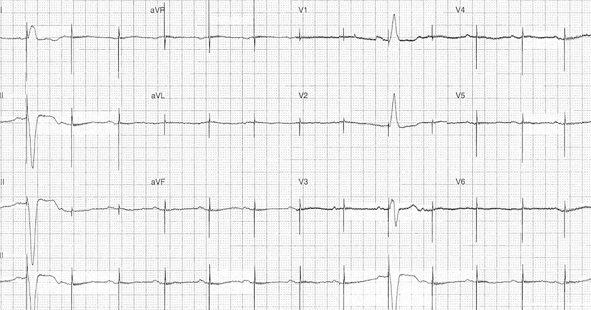 ECG of the Week: ECG of the Week - 10th September 2018 - Interpretation