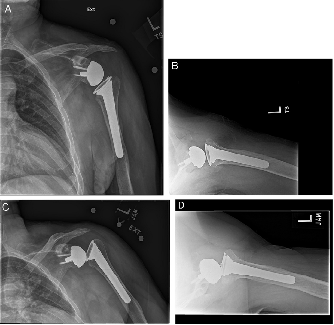 UW Shoulder and Elbow Academy: Reverse total shoulder failure from ...
