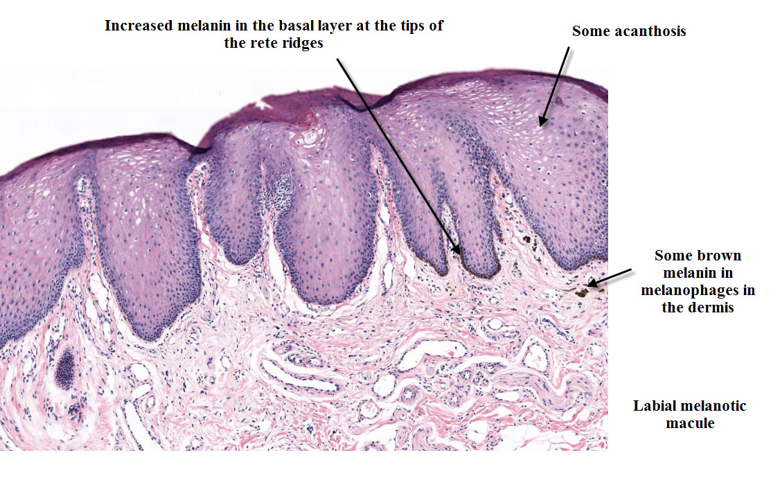 Dermpath Made Simple - Neoplastic: Benign Pigmented Lesions - Solar ...