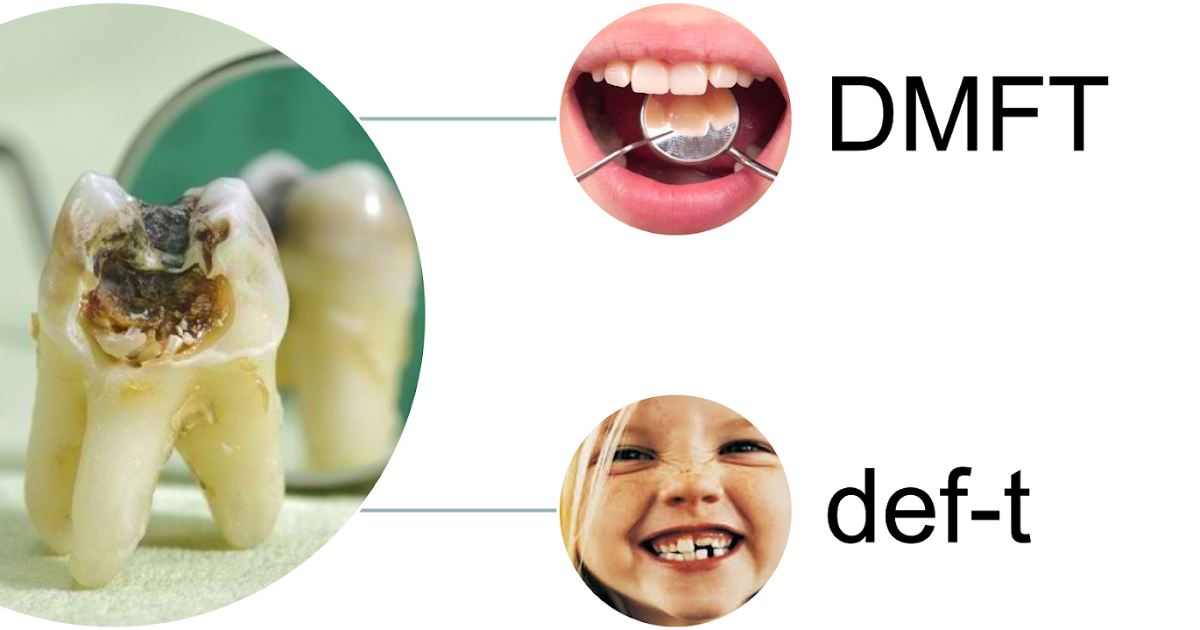 Belajar Cepat Indeks Pengalaman Karies