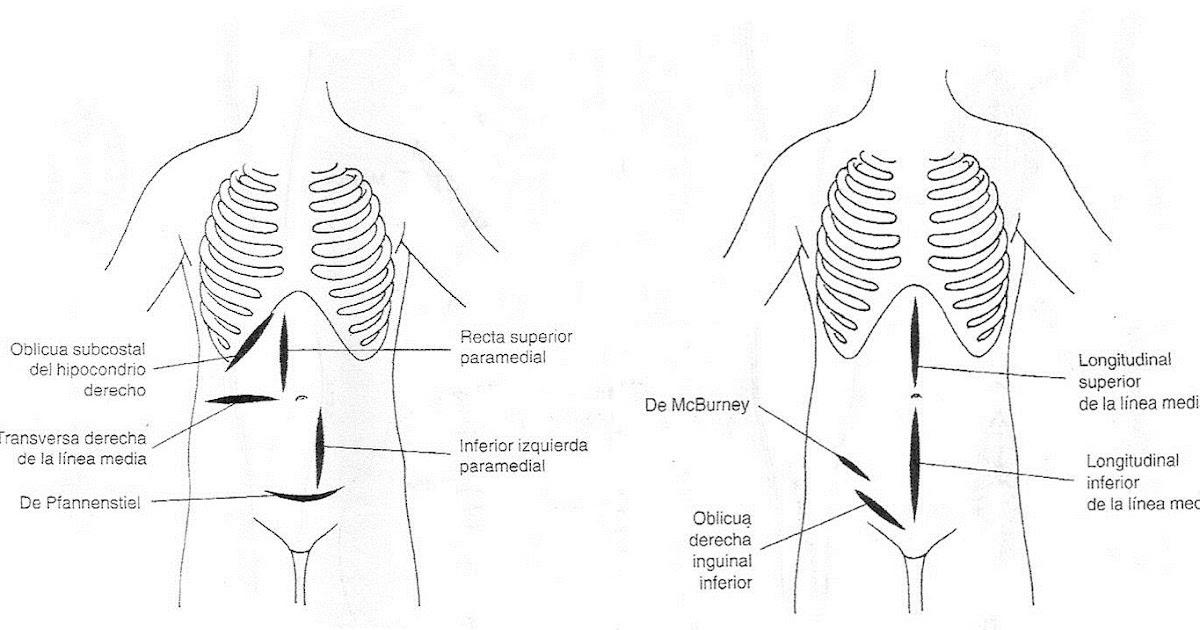 El Blog de la Arsenalera.: Incisiones abdominales