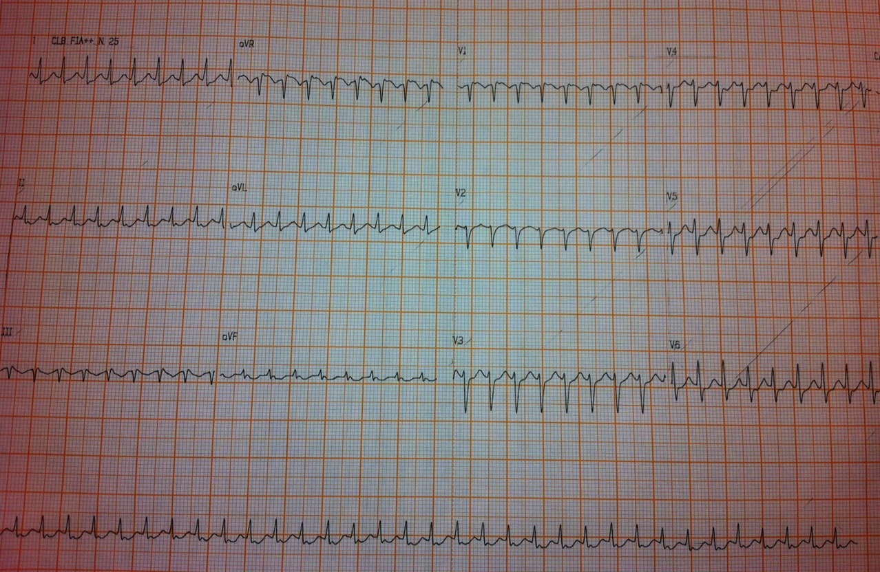 Blog de Eletrocardiografia: Março 2012