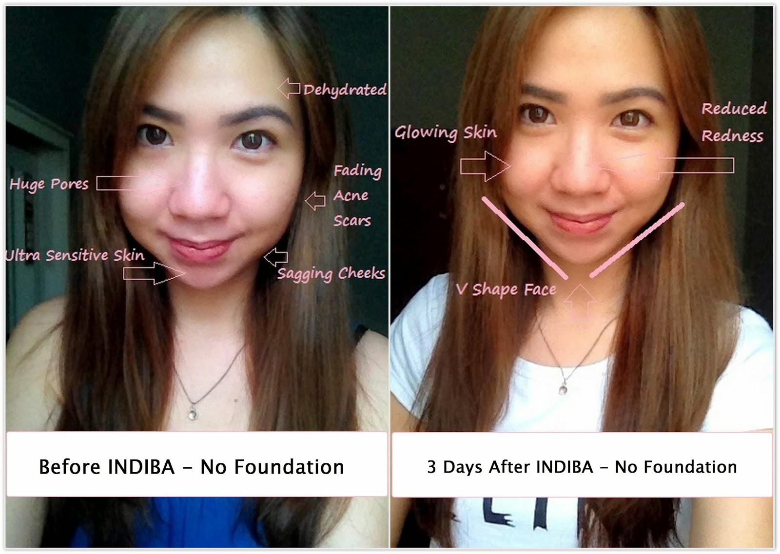 INDIBA Stemcell Treatment Review @ Bella Skin Care Malaysia - Spicy ...