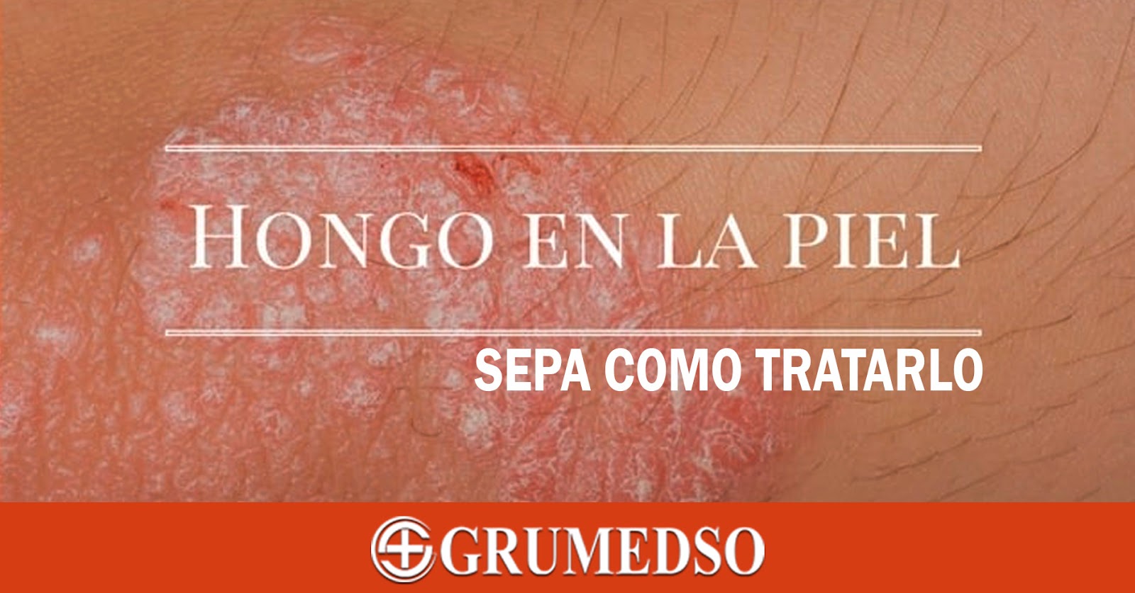 CLINICA GRUMEDSO: ¿HONGO EN LA PIEL? SEPA COMO TRATARLO