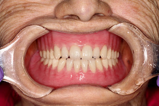 Boise Idaho Prosthodontics: Maxillary Complete Denture / Mandibular ...