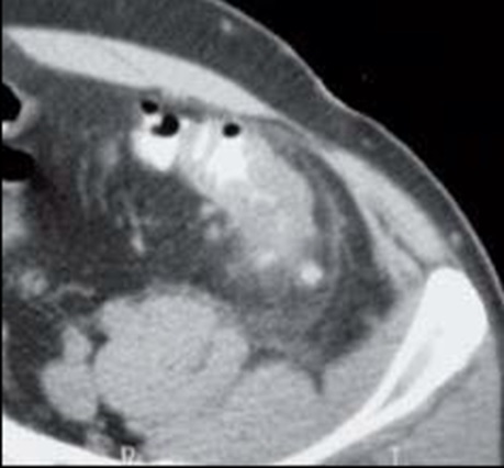 A radiologia e seus tons de cinza: CASO 5 - Paciente com Dor no Flanco ...
