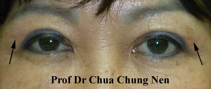 Eyelid Surgery by Prof Dr CN CHUA 蔡鐘能: Doc, Can You Remove the Excess ...