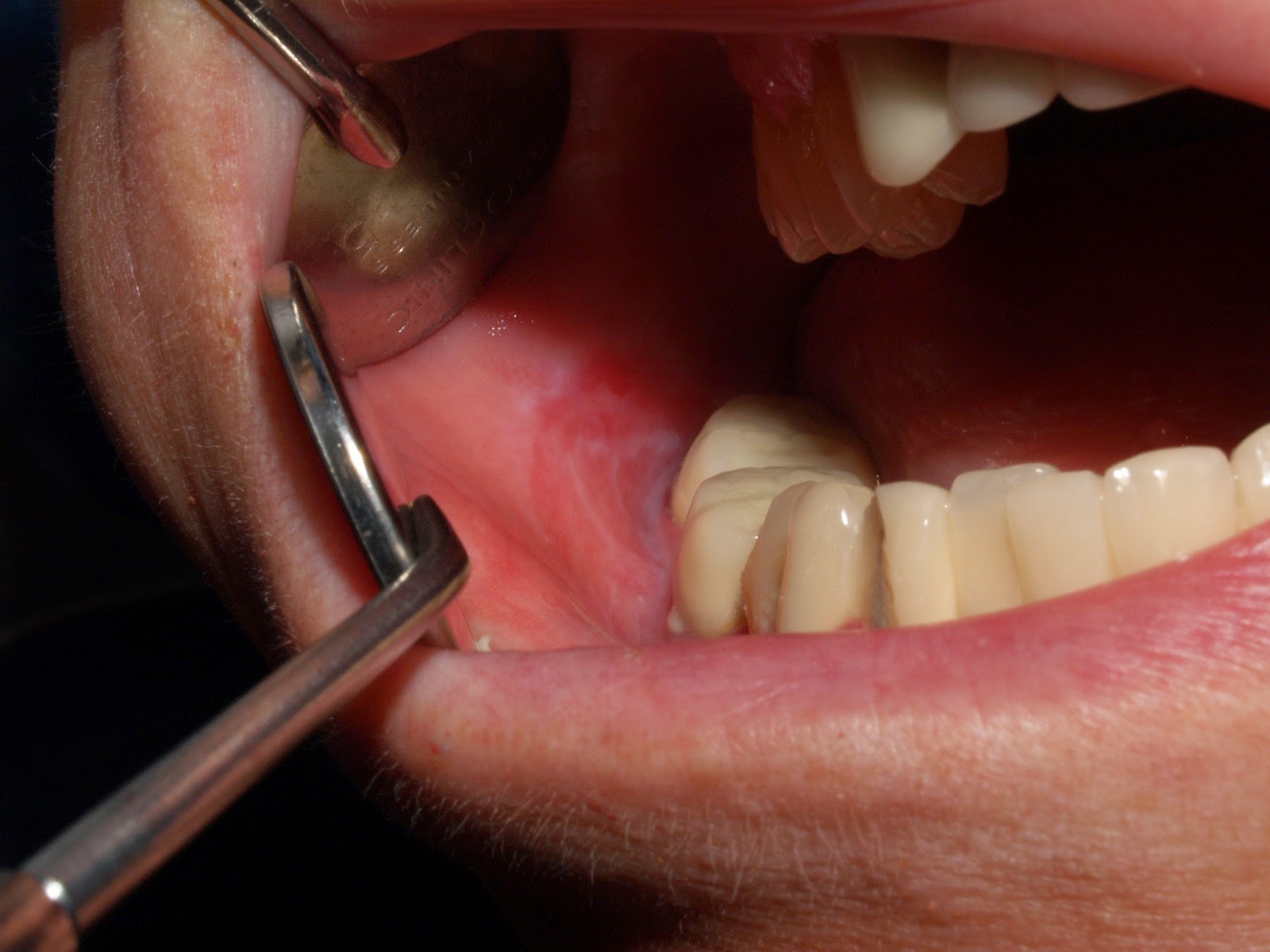 Protecciones y chalecos de moto.: ¿Qué causa el labio y lesiones en la ...