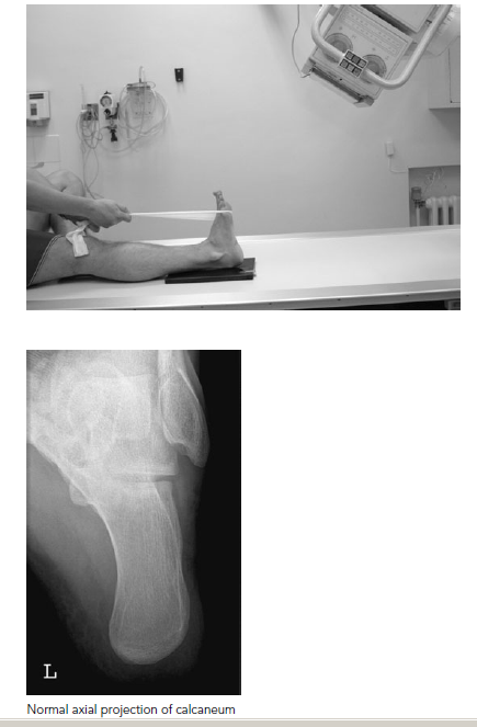 Teknik Radiografi Calcaneus