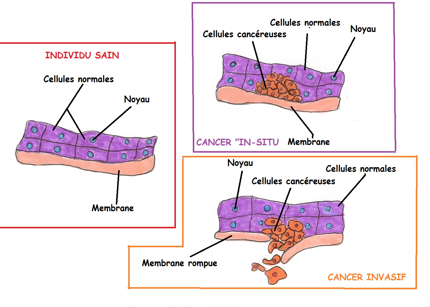Le cancer du sein TPE