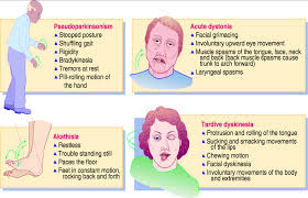 Extrapyramidal Syndrome