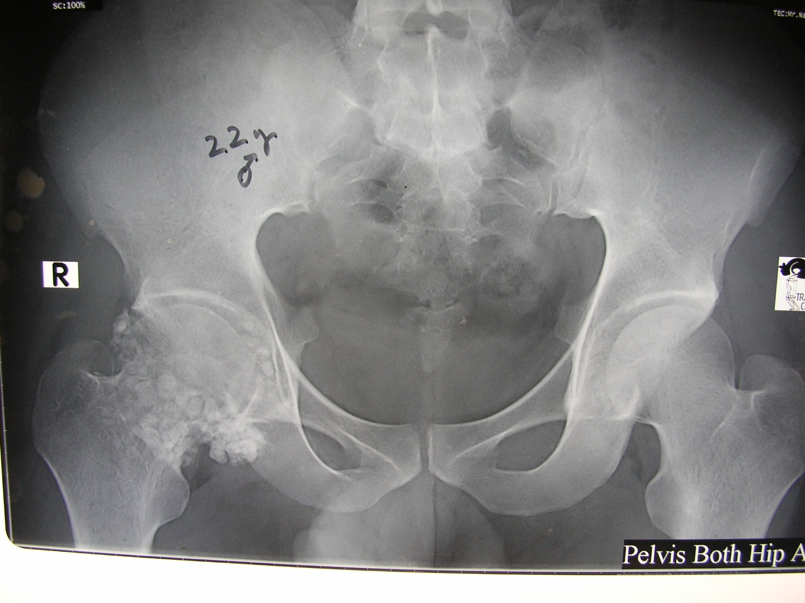 X-rays and Slides: Synovial chondromatosis in the right hip joint