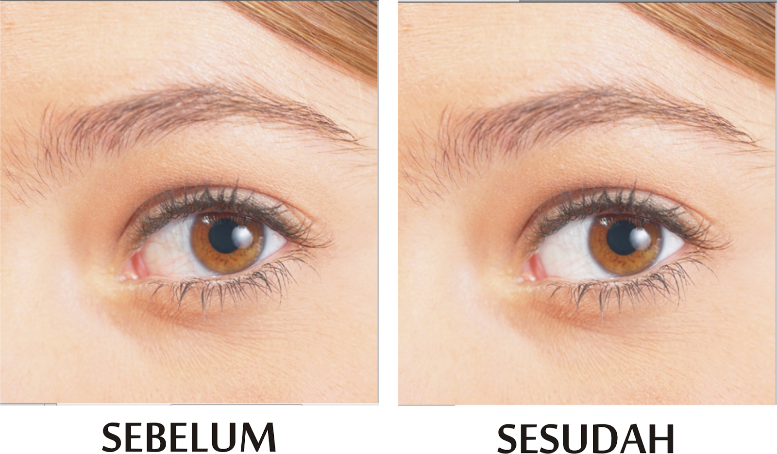 Mata Kuning - Jenis-jenis, Penyebab, Gejala dan Pengobatannya - Tips ...