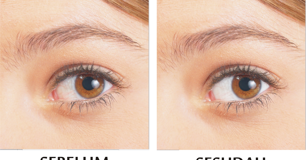 Mata Kuning - Jenis-jenis, Penyebab, Gejala dan Pengobatannya - Tips ...