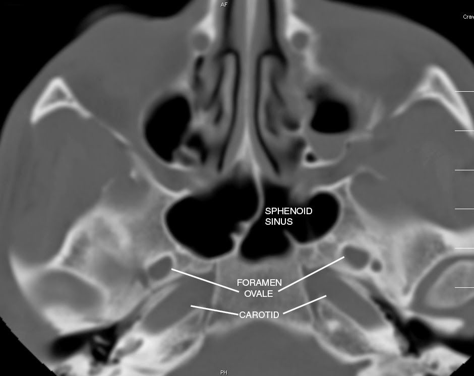 Foramen Rotundum Xray