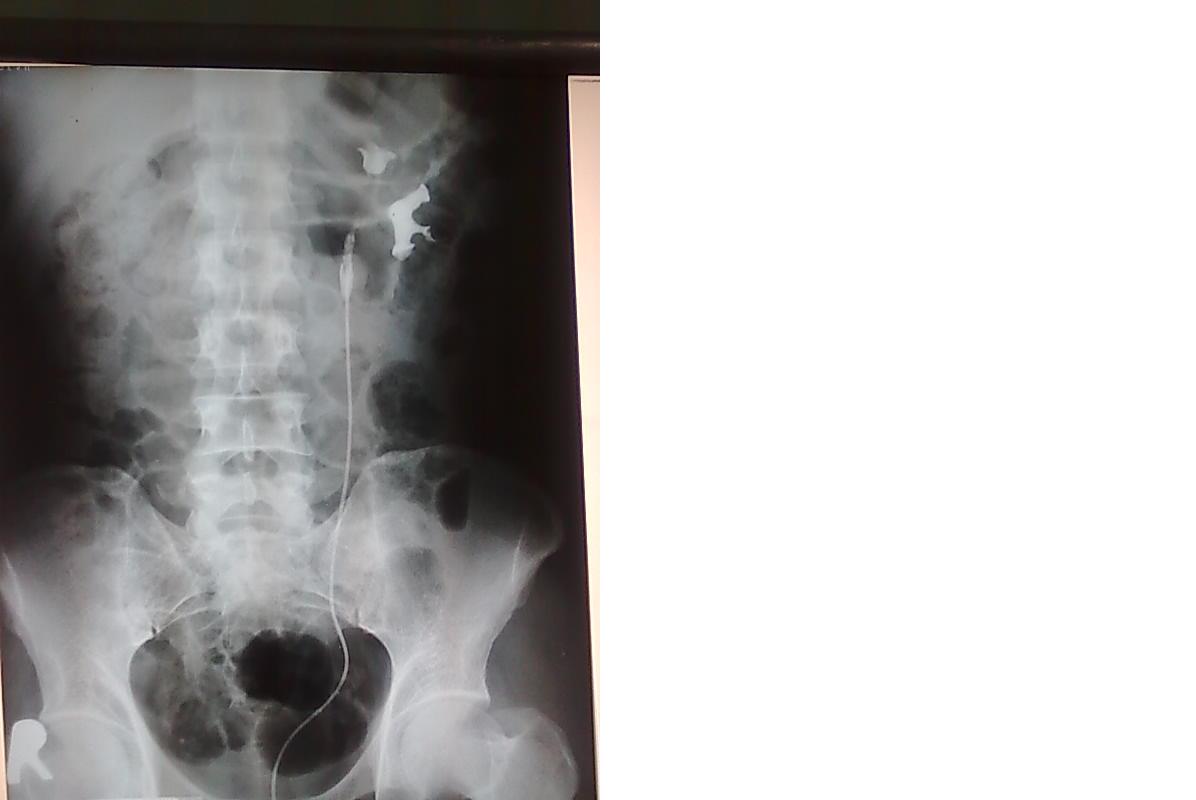 Everything Start From Here: Retrograde Pyelography