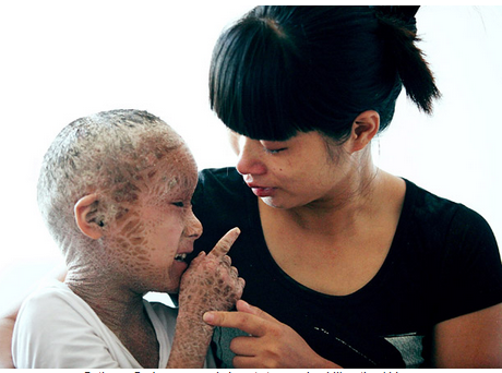 CONFESSORMISSY'S BLOG: Boy with Fish Scales on his Body.