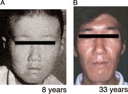 Medical Treatment Pictures-for Better Understanding: Cockayne Syndrome