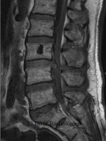 El Baúl Radiológico: ENOSTOSIS: ISLOTE ÓSEO (Bone Island: CT and MRI ...
