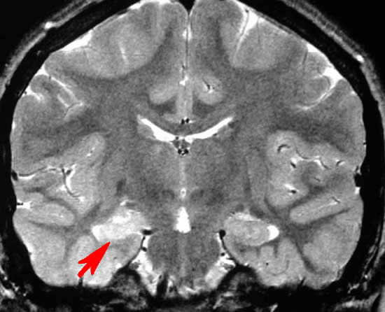 MAGNETIC RESONANCE IMAGING OF BRAIN: MRI BRAIN
