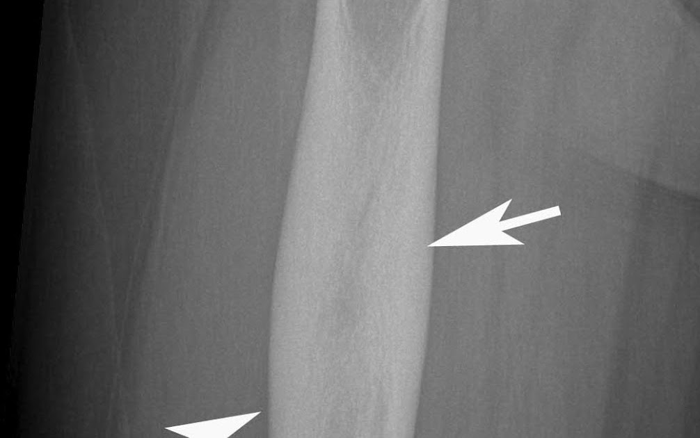 RiT radiology: Osteoid Osteoma