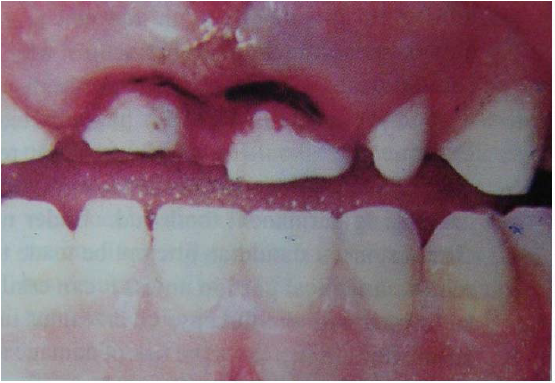 Ellis and Davey Classification - Endodontics and Oral Implantology