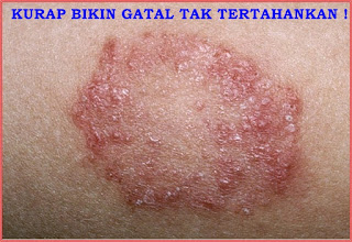 Tips Mengobati Panu dan Kurap Secara Alami dan Cepat