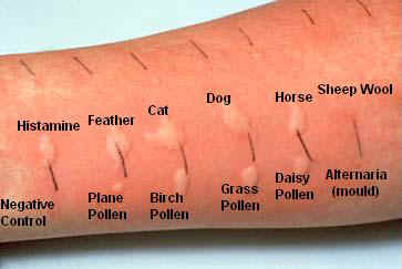 Open Up Ur Heart...: Alergi Pada Anak