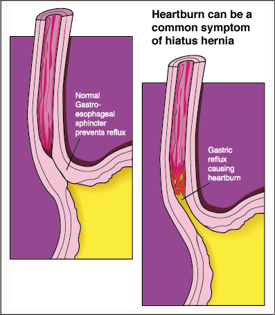 Hiatus Hernia: Alternative healthcare for GERD & Hiatus Hernia
