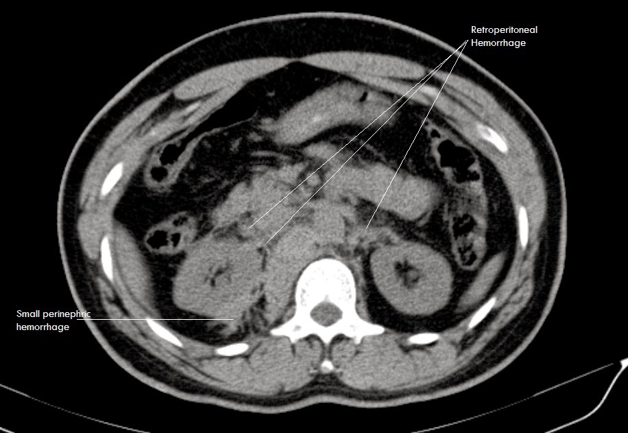 Ultimate Radiology : Active arterial extravasation in Blunt Abdominal ...