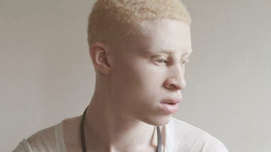 Sociedade africana: O negro albino.: Fotos de negros albinos