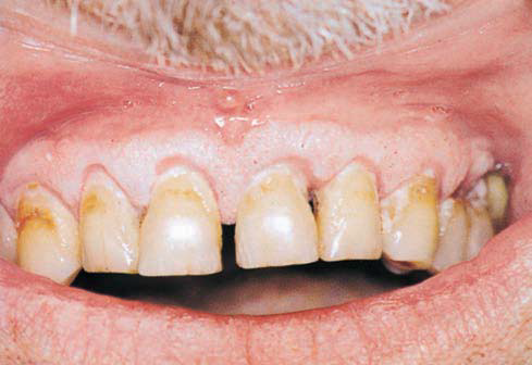 Healthy Ranula: White Lesions of Oral Mucosa
