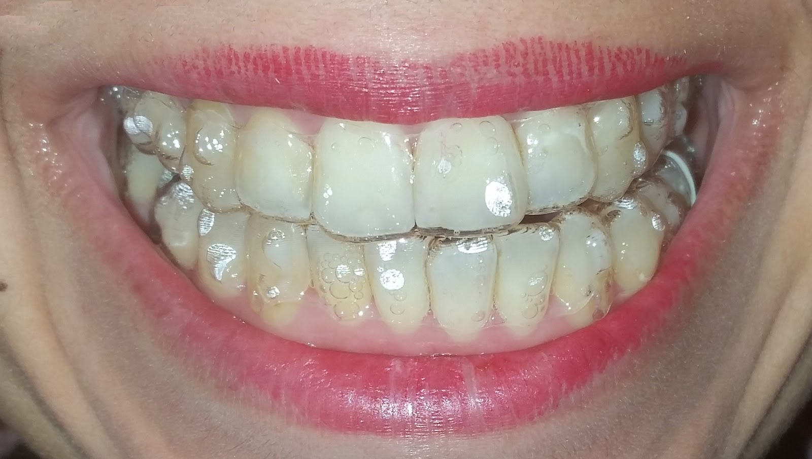 Mejorando mi sonrisa con INVISALIGN: diciembre 2015
