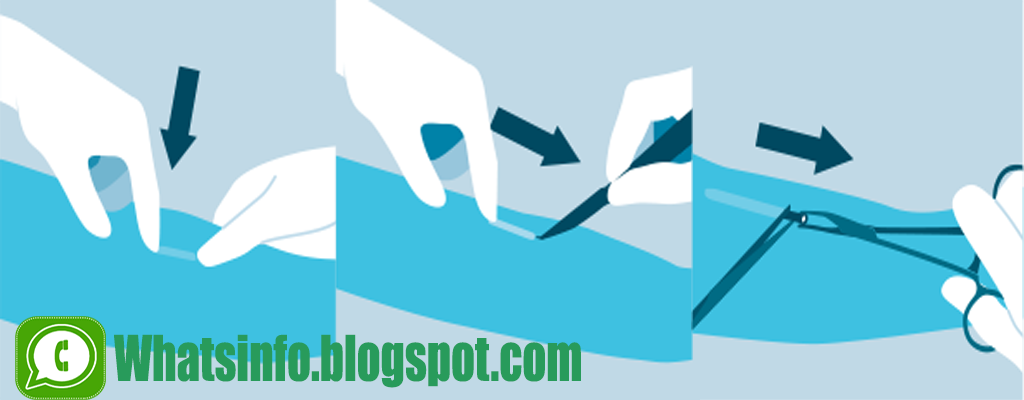 To Remove Implanon Failure