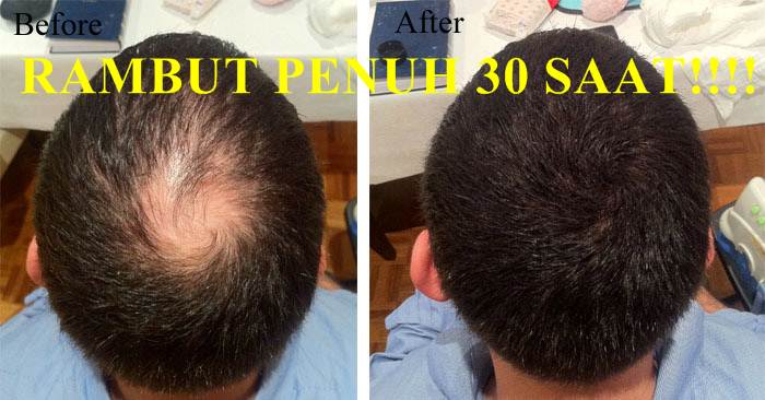 Masalah Rambut Gugur dan Rawatan Gugur Rambut Di Malaysia