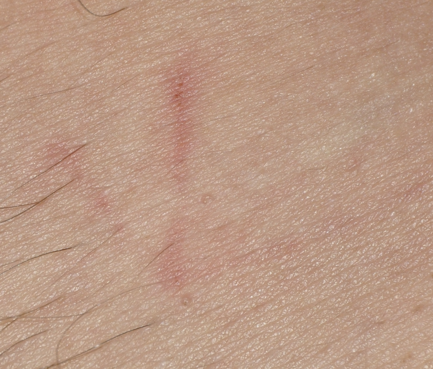 Experiential Dreaming: Red Grid Marks Case Report #2: 'Antal'