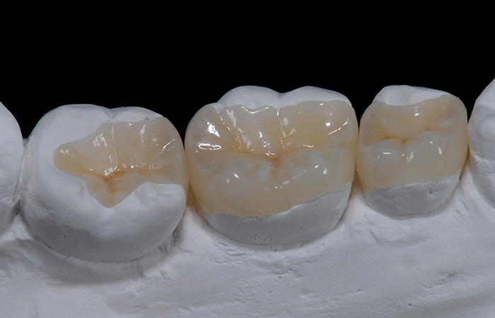 Restaurações dentais indiretas ( Inlay, Onlay, Crown - Overlay ...