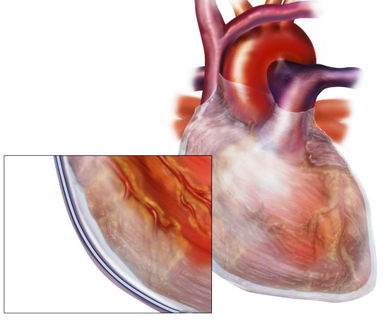 Causas de Pericardite - As Doenças Cardíacas