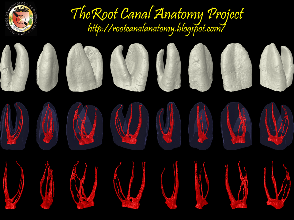 The Root Canal Anatomy Project Middle Mesial Canal Maxillary First Molar