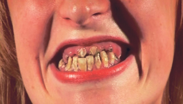 Heekan turinoita: Juttua hampaista