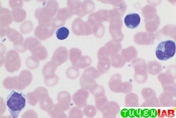[Haematology] Abnormalities of the White Cell Series | Free Medical Atlas